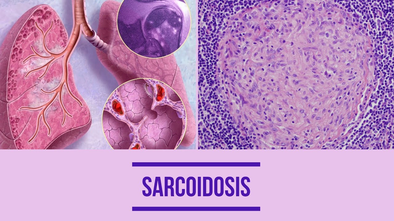 Sarcoidosis | cause |symptoms | diagnosis | management |granulomatous ...