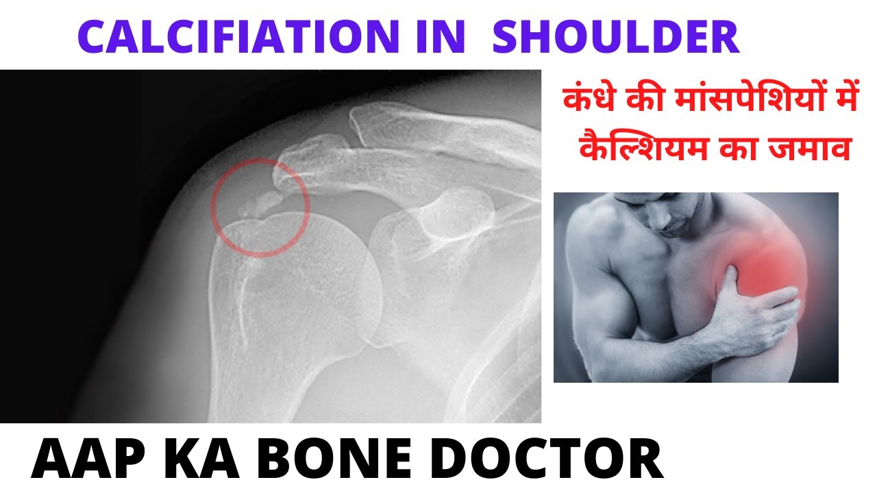 CALCIFICATION IN SHOULDER MUSCLE. EPISODE 15 - YouTube