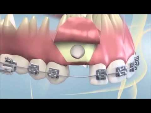 Impacted Canine Exposure - YouTube