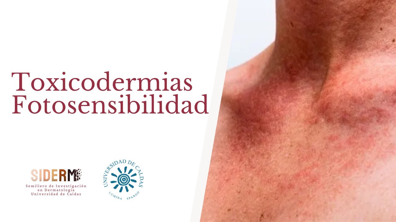 Revisión Toxicodermias Fotosensibilidad - YouTube