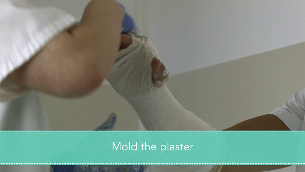 Yeso Antebraquial - Fracture & Plaster - YouTube