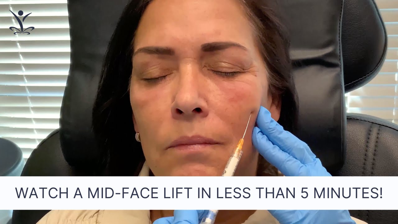 Cheek Filler for a Mid-Face Lift - YouTube