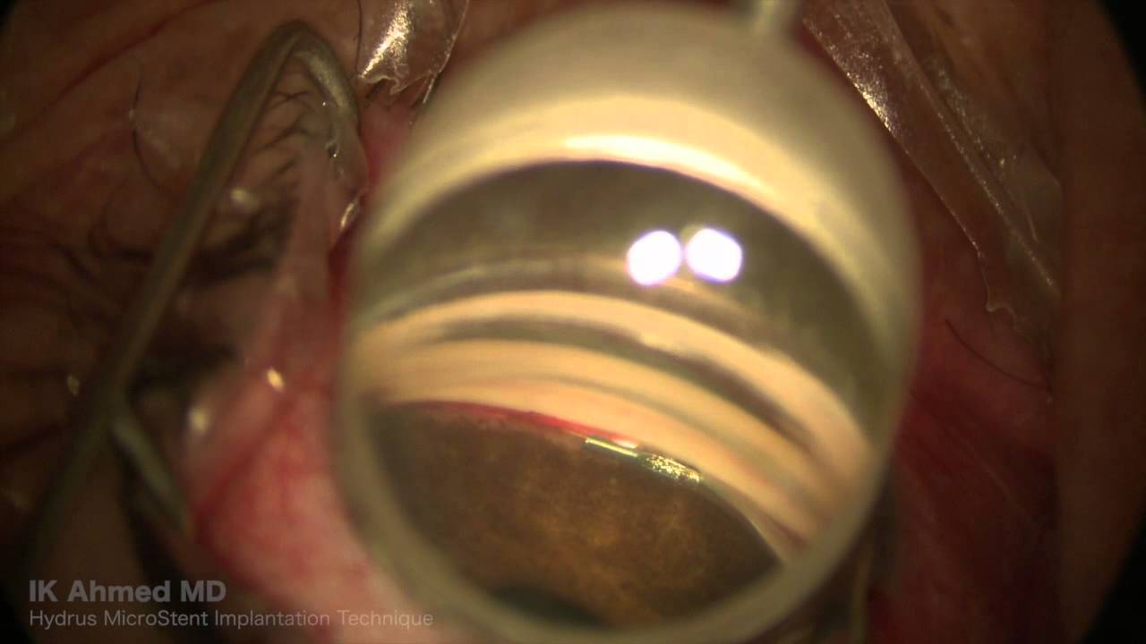 Hydrus micro-stent for glaucoma AHMED - YouTube