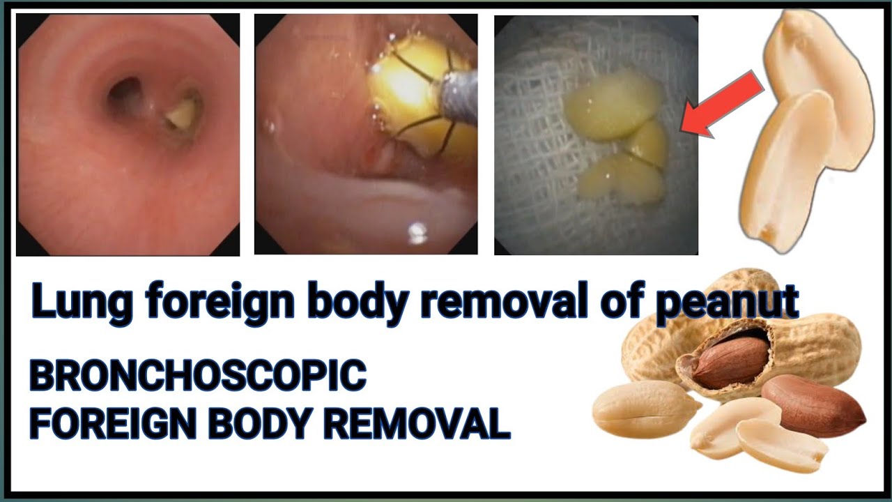 Lung Foreign Body Removal of Peanut at SQUARE HOSPITALS LTD Dhaka ...
