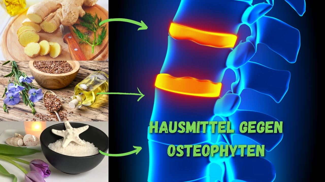9 Natürliche Hausmittel gegen Osteophyten - YouTube