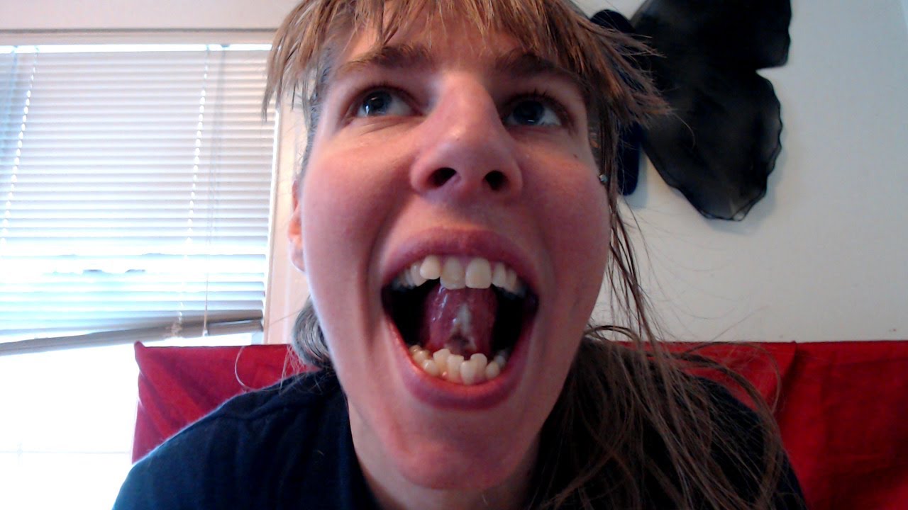 Post-Frenectomy Exercises (The Right Way!!) Day 4 + Infected? Find Out ...