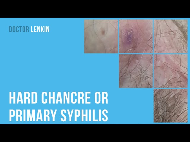 Syphilis Chancre Scrotum