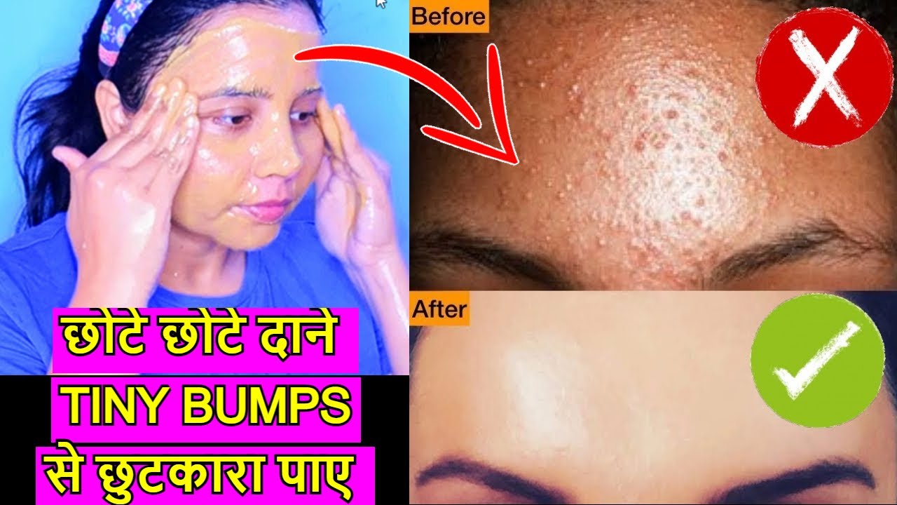 Get Rid of Tiny Bumps/Small Pimples From Forehead, Chin, Cheeks ...