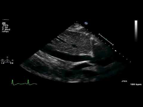 TTE Normal SubCostal IVC Example 1 - YouTube