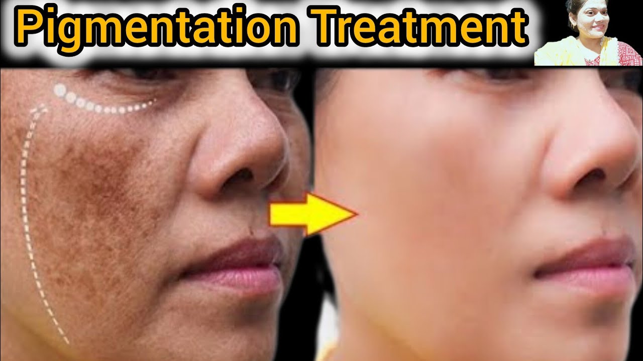 How To Remove Pigmentation l झाइयां और मुंहासों को कहो अलविदा l Pack ...