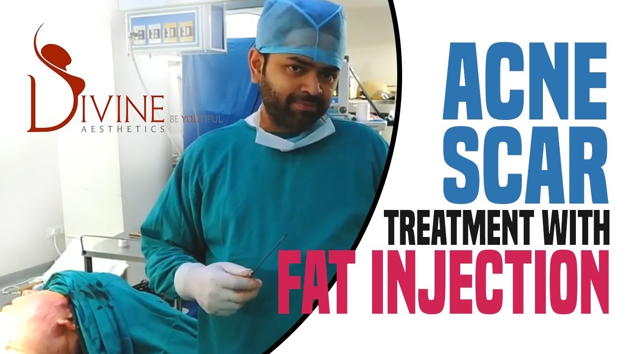 Acne Scar Treatment with Fat Injection - YouTube