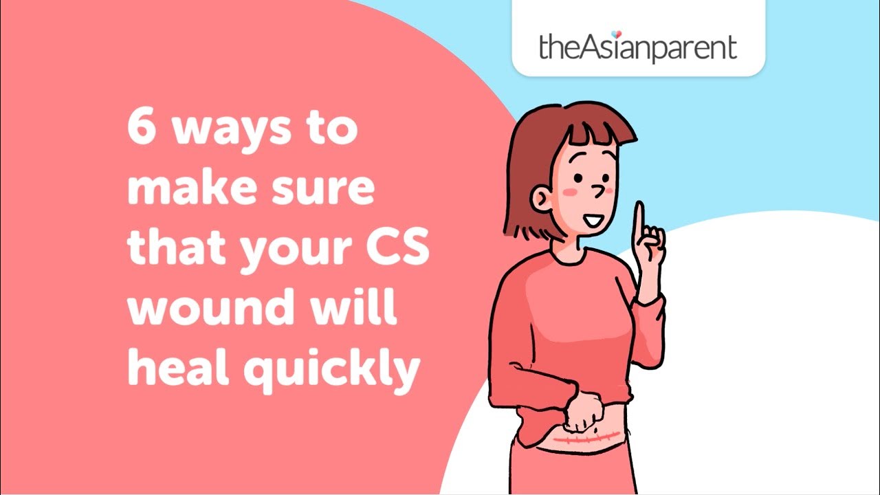 6 ways to make sure that your CS wound will heal quickly ...