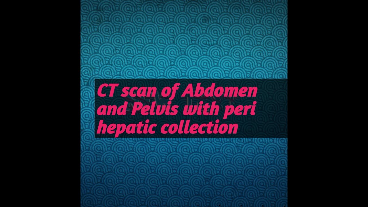 CT scan of abdomen and pelvis with Hepatic,liver protocol - YouTube