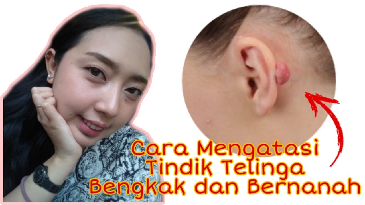 Cara Mengatasi Tidik Telinga yang Bengkak dan Bernanah - YouTube