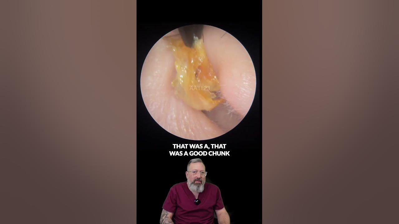 Huge Ear Wax Plug Removal! Chunky Skin Peels & Shocking Extractions 😱👂- EP1123 Highlights - YouTube