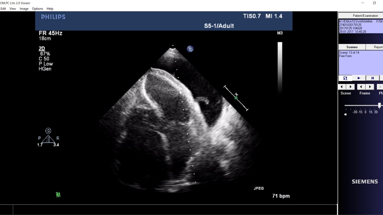 right atrial thrombus - YouTube