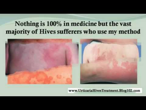 urticaria pigmentosa - urticaria treatment - papular urticaria - YouTube