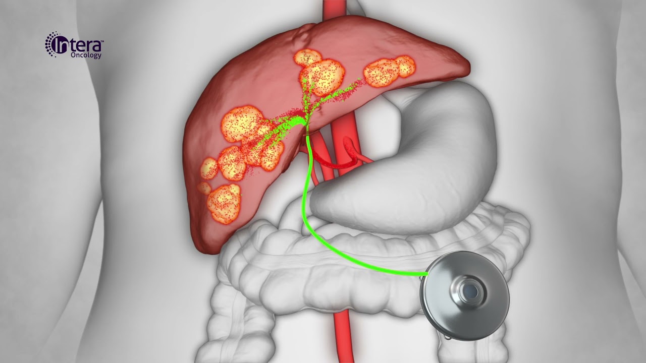 HAI Therapy - How the Therapy and Intera 3000 Pump Works? - YouTube