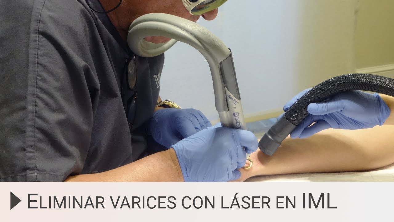 Eliminar Varices con Láser en IML Madrid - YouTube