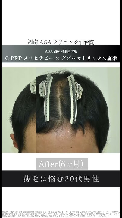 薄毛治療毛根再生注射（ダブルマトリックス）×C-PRPメソセラピー施術#aga #薄毛 #仙台 - YouTube