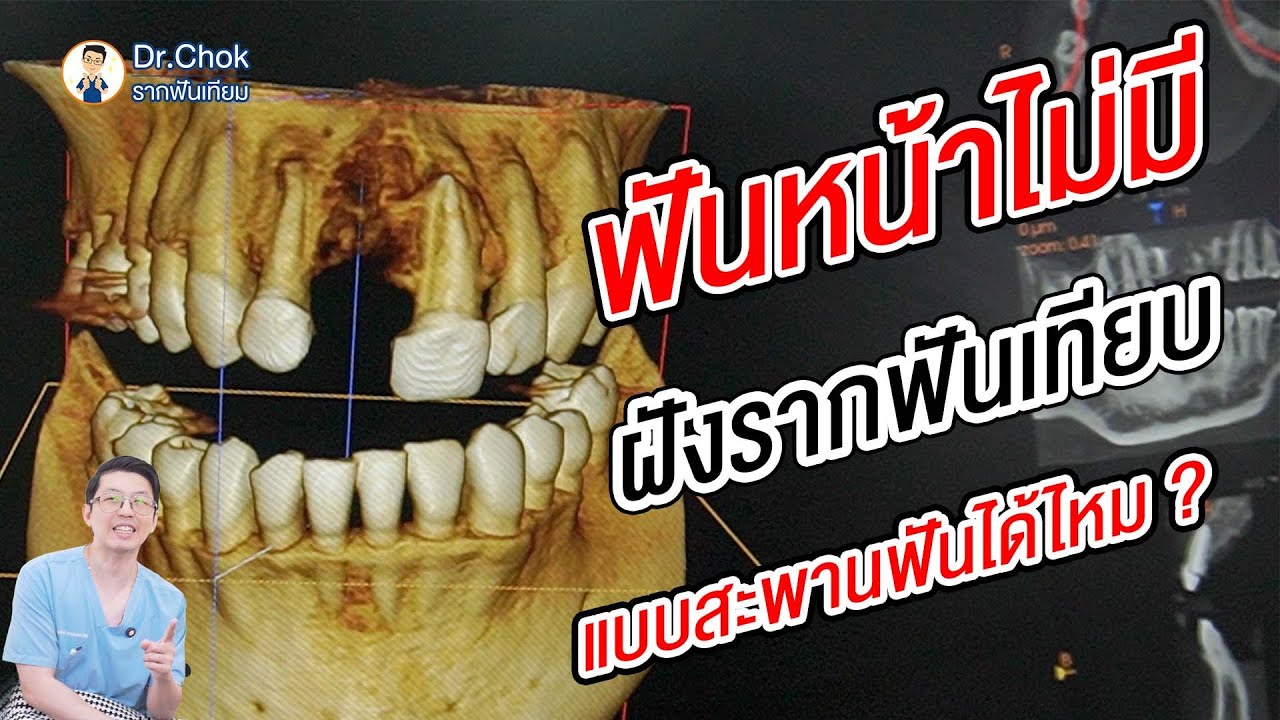 ฟันหน้าไม่มี ฝังรากฟันเทียม แบบสะพานฟันได้ไหม ?!! | คลายปัญหารากเทียม ...