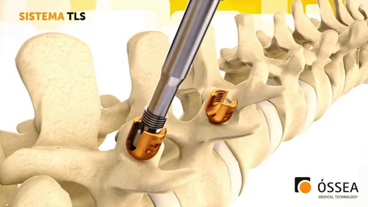 Técnica Cirúrgica - Sistema TLS - Óssea - YouTube
