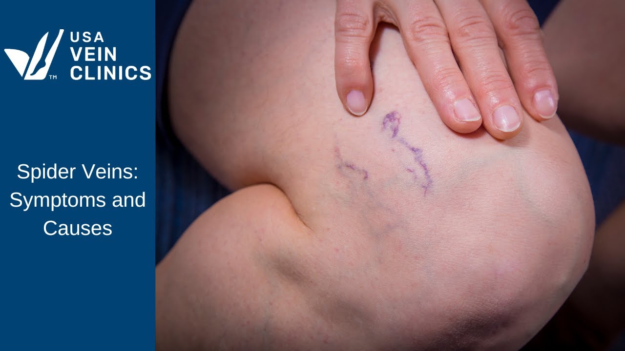 Spider Veins: Symptoms, Causes, Treatments - YouTube