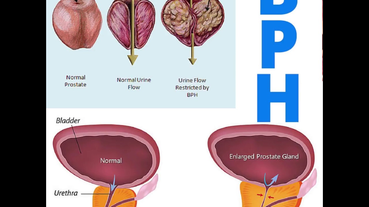 What is BPH? Benign Prostatic Hyperplasia Explained - Dr. David Samadi ...