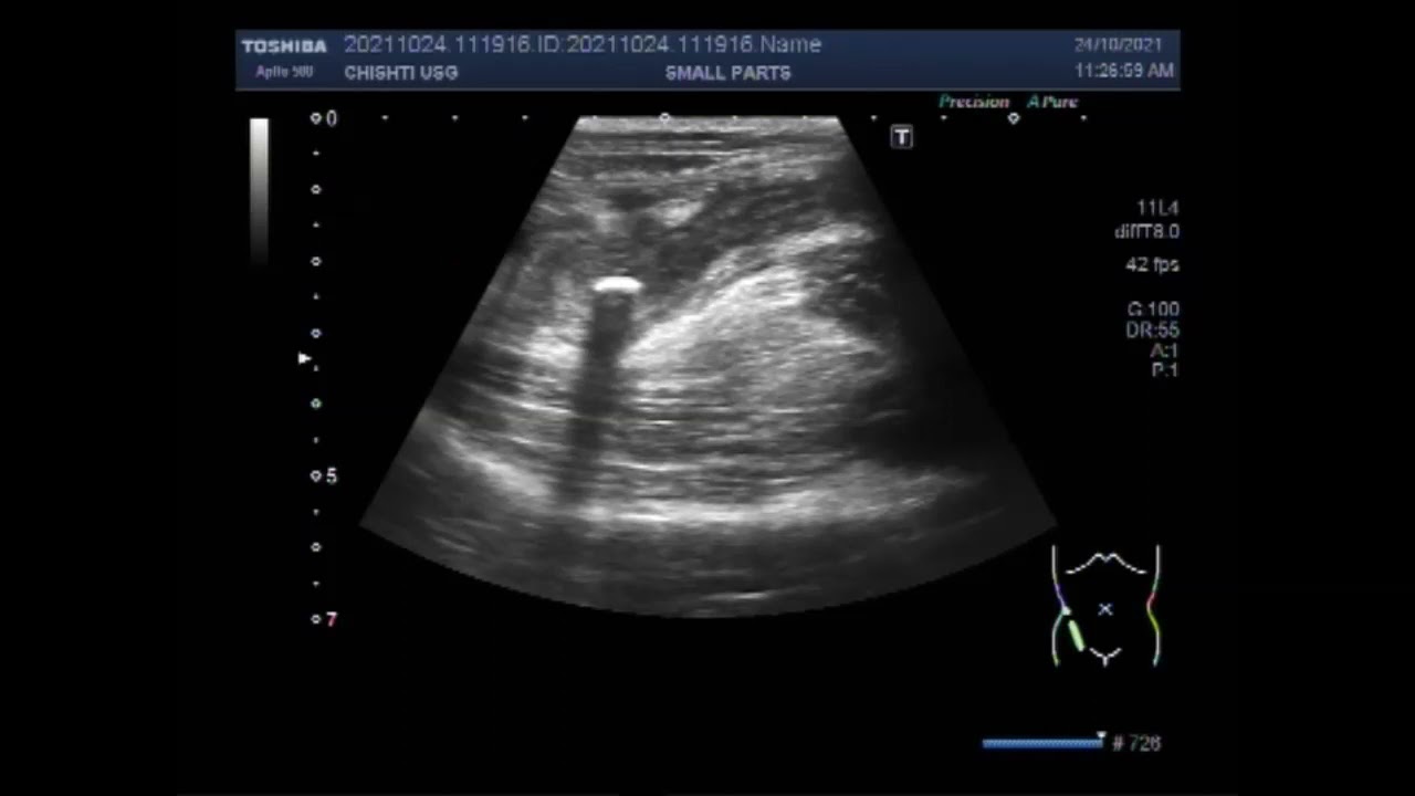 Scanning and Focusing of Inflamed Appendix with Fecolith seen in its ...