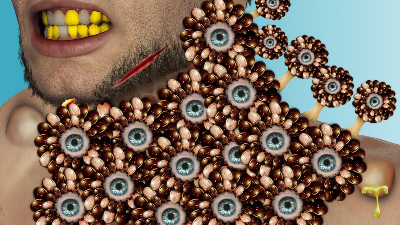 ASMR Removal Maggots & Worm Infected Neck Severely Injured Animation ...