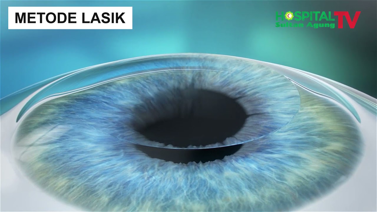 Metode-Metode Tindakan Operasi Laser Vision Correction (LASIK) di RSI ...