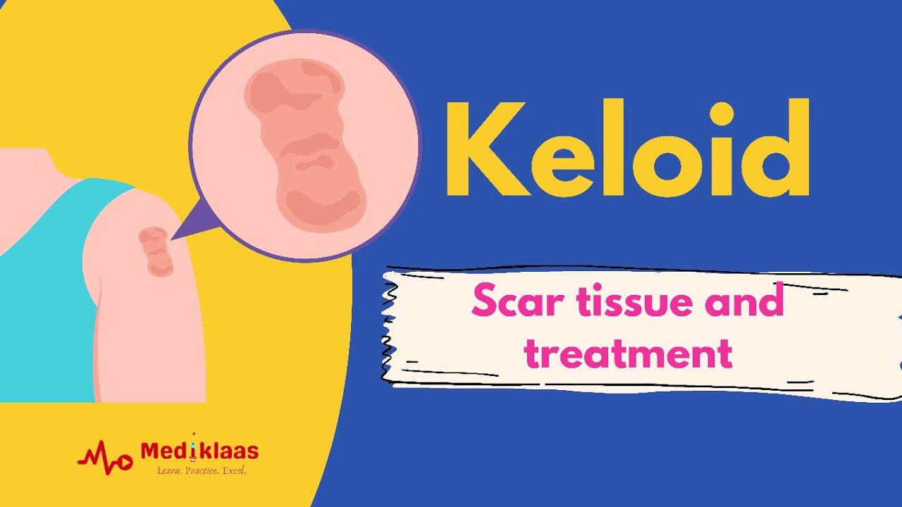 Keloid- scar tissue and treatment? - YouTube