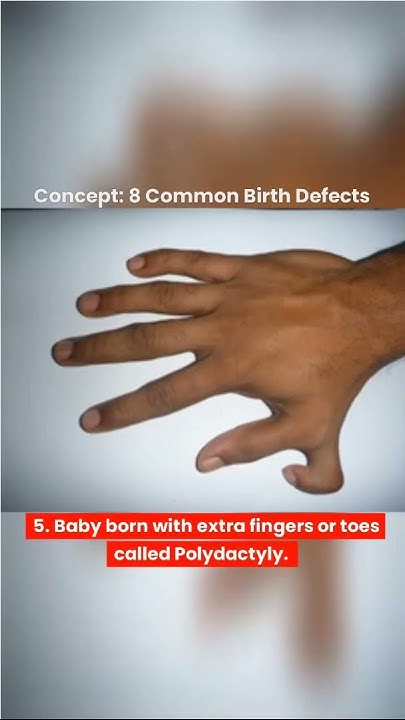 Human Body Fact 2: The 8 most common birth defects are: - YouTube