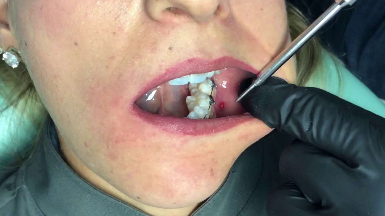 Mini-implante extra-alveolar em buccal shelf - YouTube