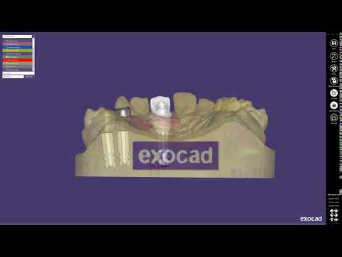 exocad DentalCAD Implant Module case example - YouTube