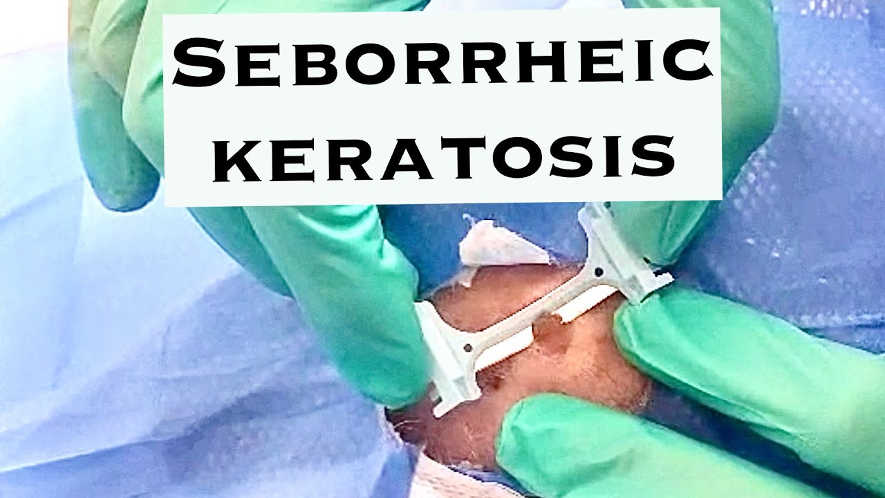 Seborrheic Keratosis Shave Excision & Curettage | Dr Derm Diaries - YouTube