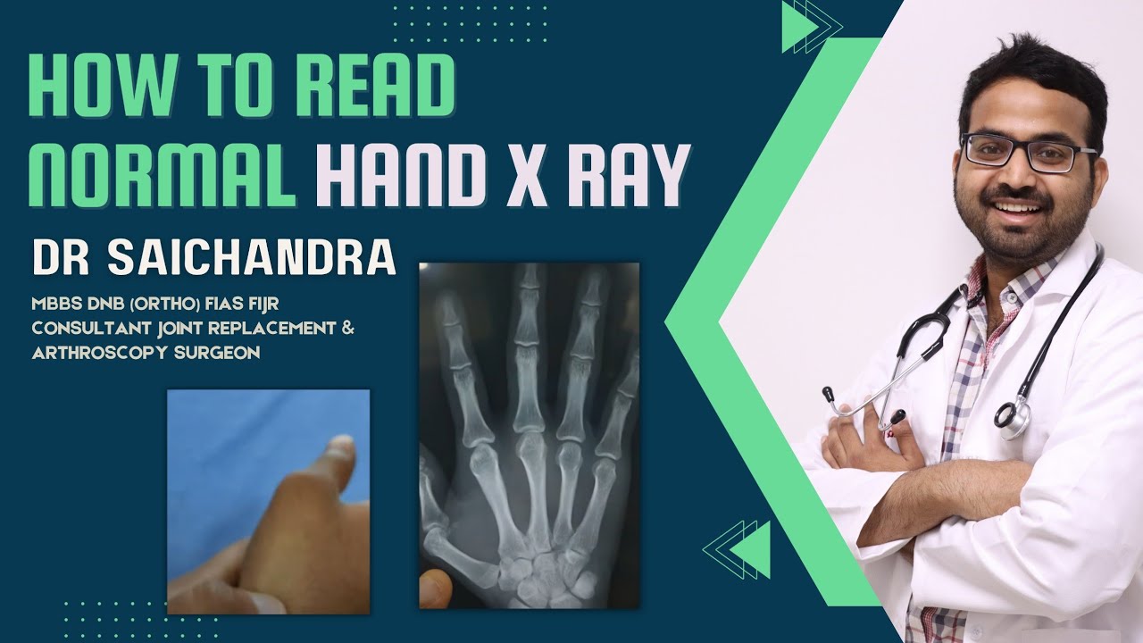 How To Read Normal Hand X Ray..Dr Sai Chandra MBBS DNB (Ortho) - YouTube