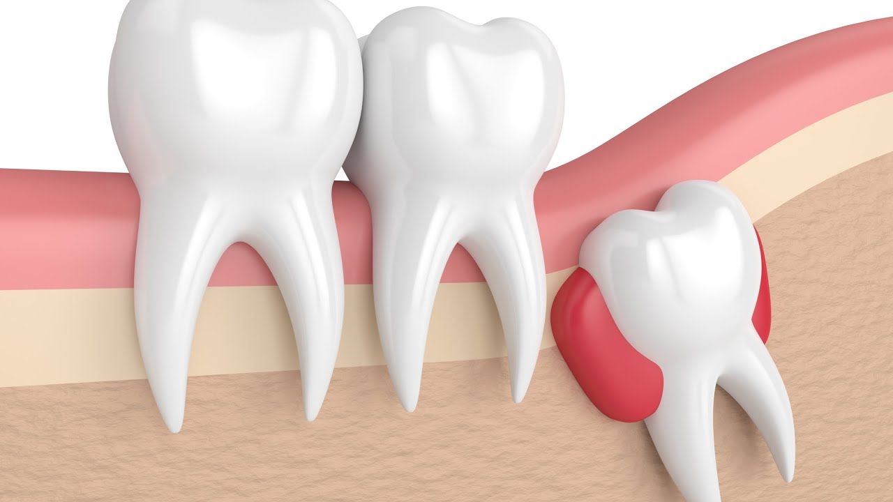 Impaction Part 4 (WAR lines and WHARFE Assessment) - YouTube