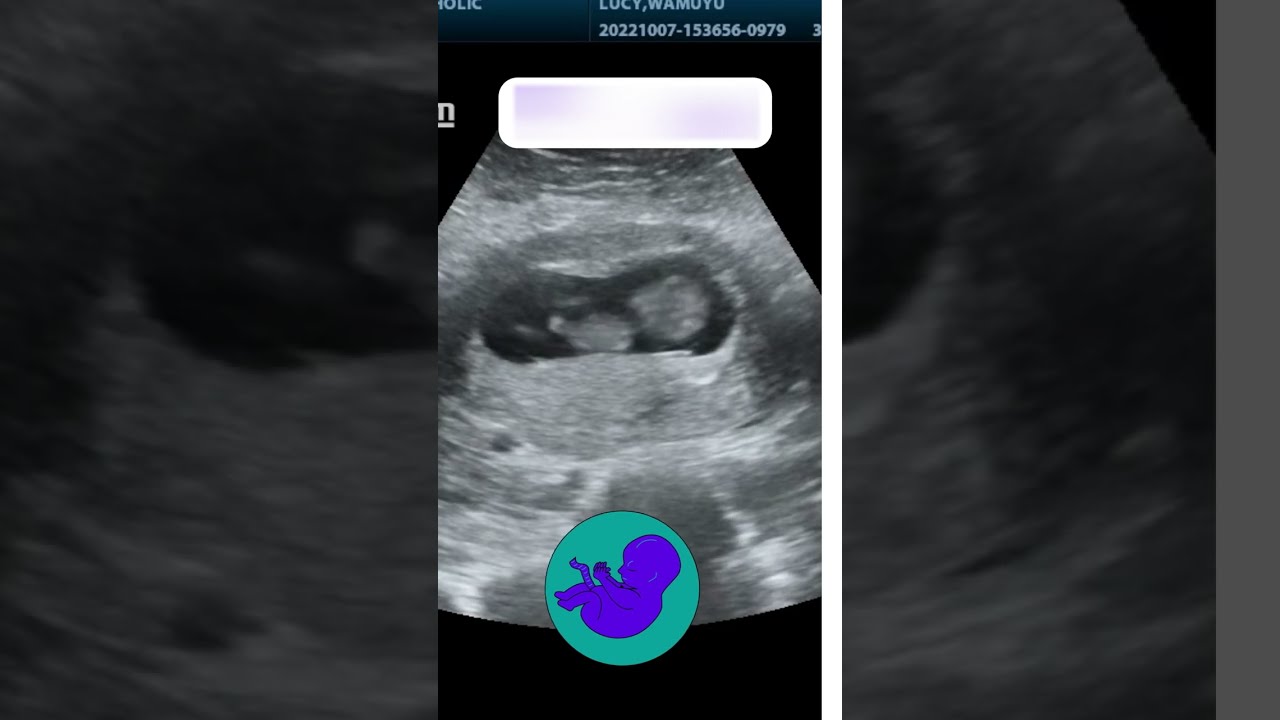 Fetal ultrasound of 7 weeks 2 days | Mother thinks it's baby boy moving ...