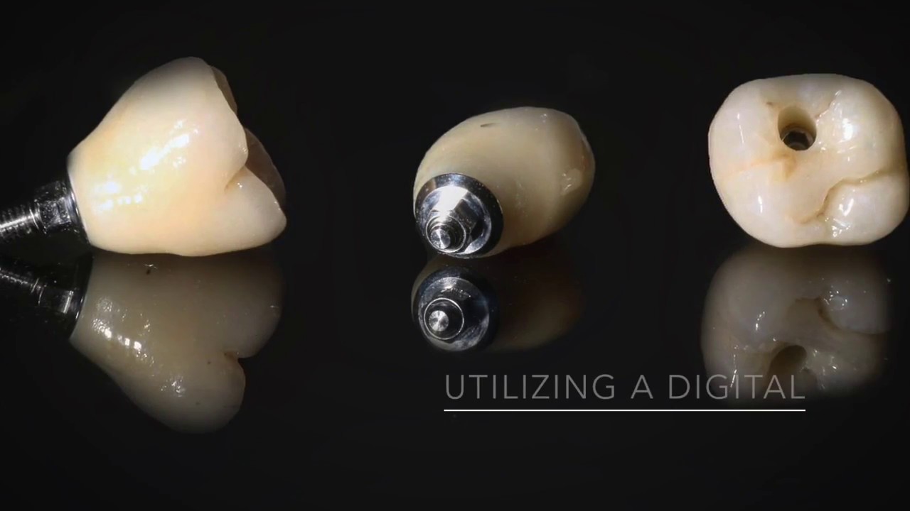 Digital implant dentistry workflow - YouTube