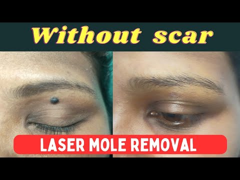 Scarless mole removal| Mole removal with CO2 laser| Mole removal in ...