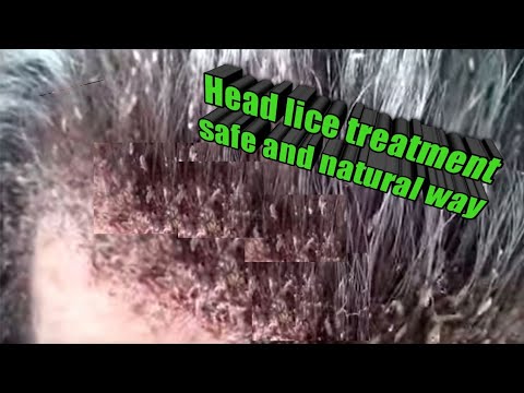 Head lice treatment the safe and natural way/how to remove lice from ...