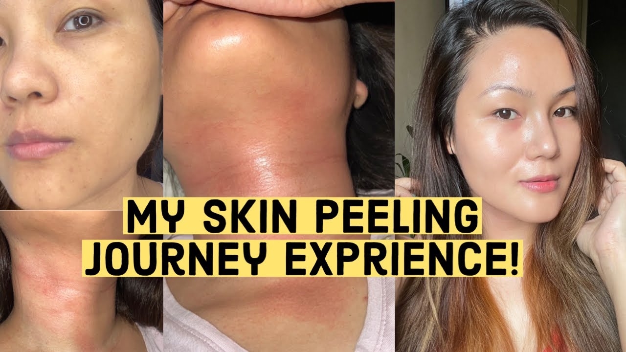 Dr Alvin the orginal Rejuvenating Peeling set || Peeling journey ...