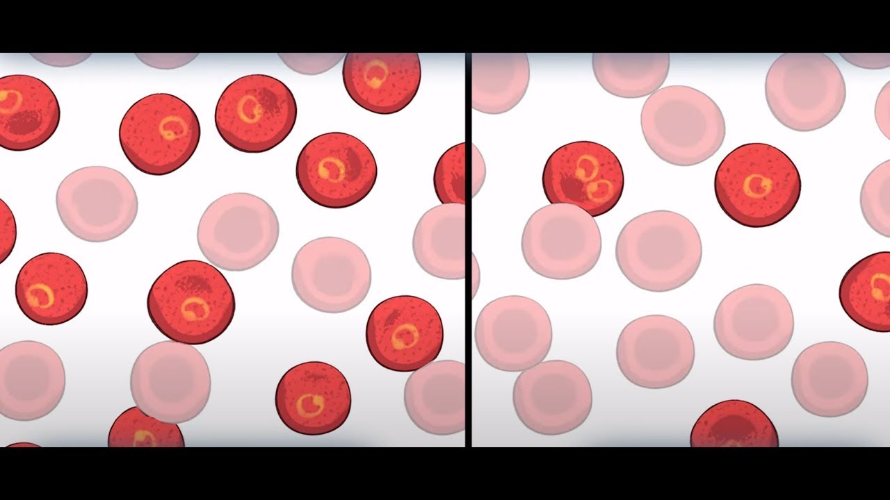 Sickle Cell: Natural Selection in Humans | HHMI BioInteractive Video ...