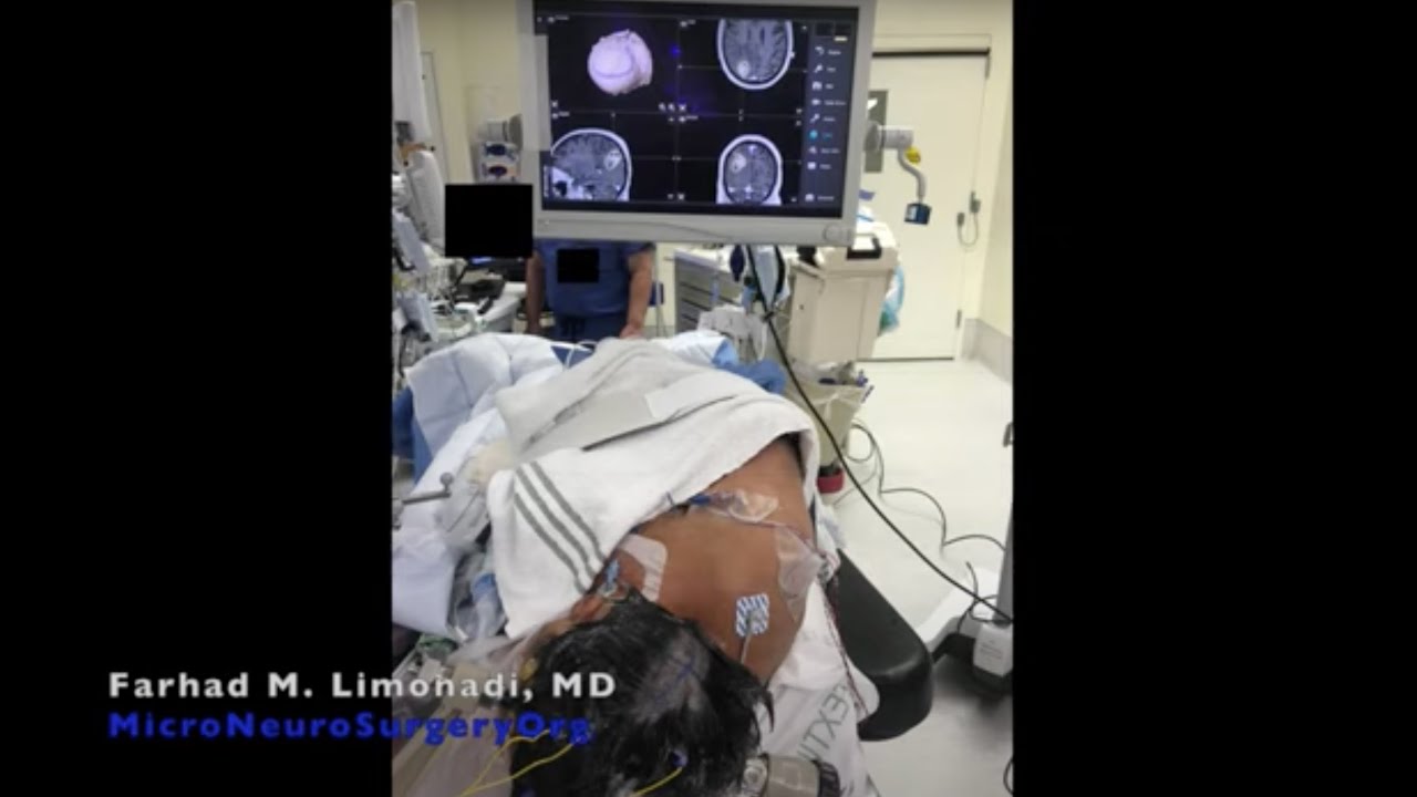 Brain surgery: Parietal craniotomy for resection of metastatic brain ...