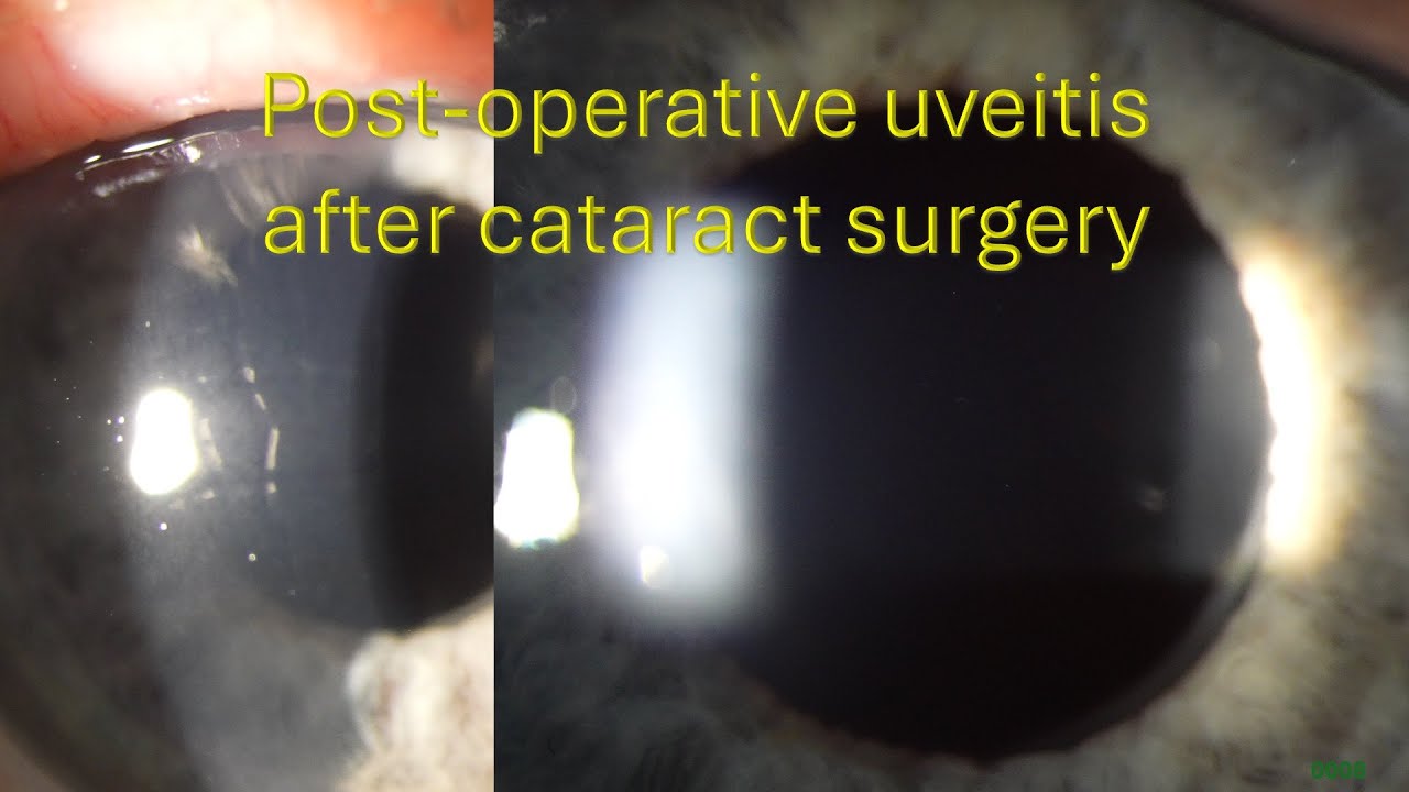0008: Post-operative uveitis after cataract surgery - YouTube
