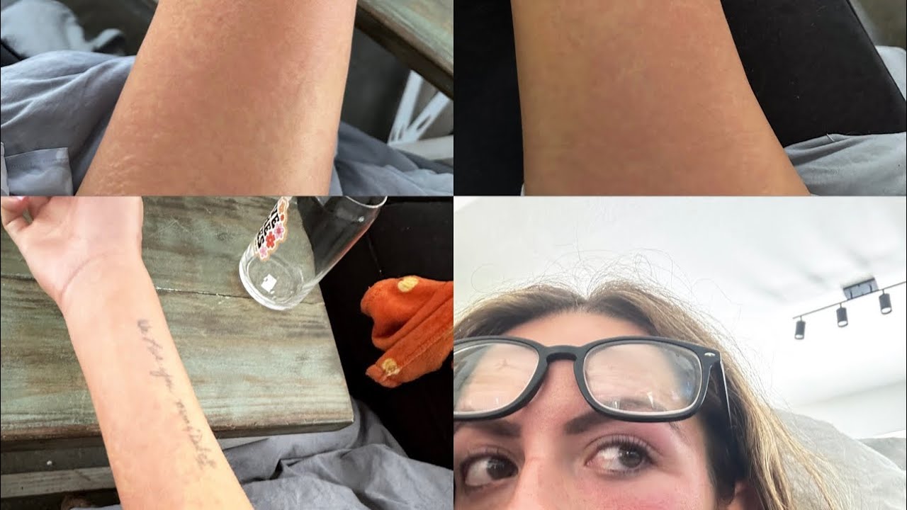 3 MONTHS SINCE THE BEE ACCIDENT! (100+ Stings) - YouTube