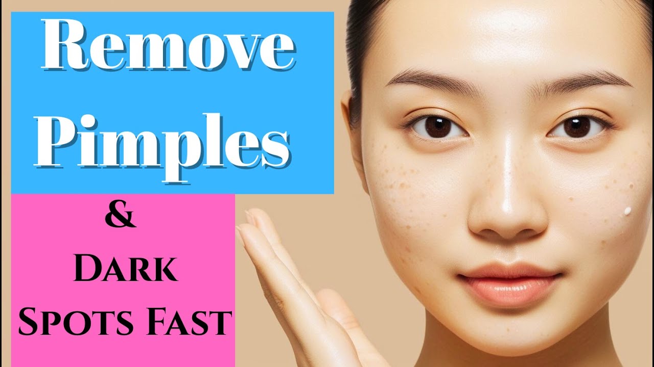 How To Remove Pimples And Dark Spot Natural Homemade Remedy Solution 100 Effective YouTube how-to-remove-pimples-and-dark-spot-natural-homemade-remedy-solution-100-effective-youtube