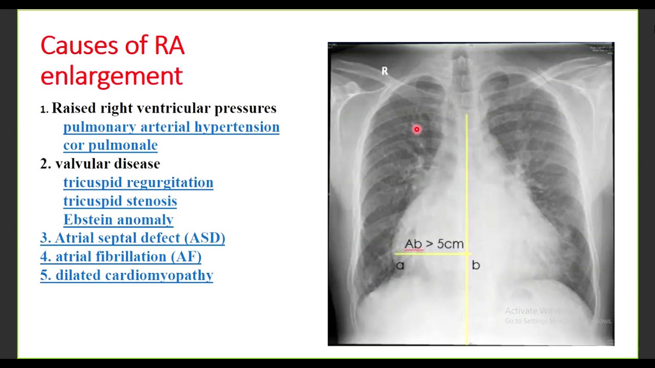 Approach to Chest X-ray in Cardiac Disease - Prof Dr Tom Devasia - YouTube