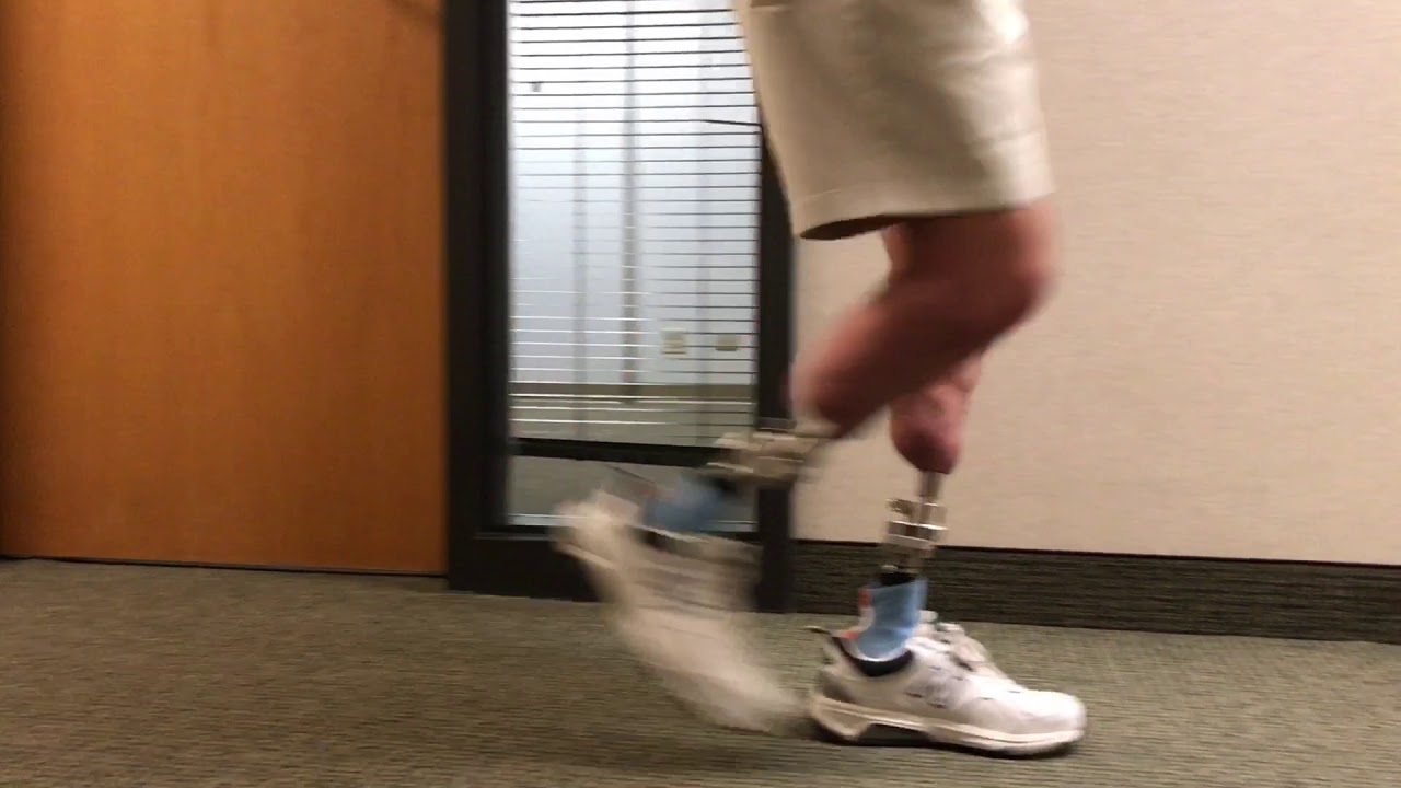 Below knee Osseointegration - Improved Walking Ability and Speed - YouTube